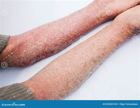 Man With Sick Hands Dry Flaky Skin On His Hand With Vulgar Psoriasis