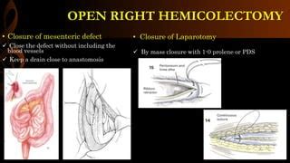 Open Right Hemicolectomy Step By Step Operative Surgery Pptx