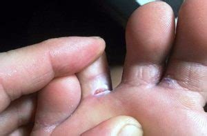 What Causes Cut Under Toe Crease
