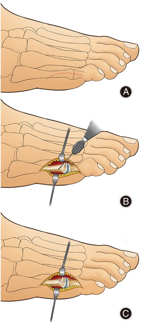 The Weil Procedure Linear Incision That Made Overlying The Fifth