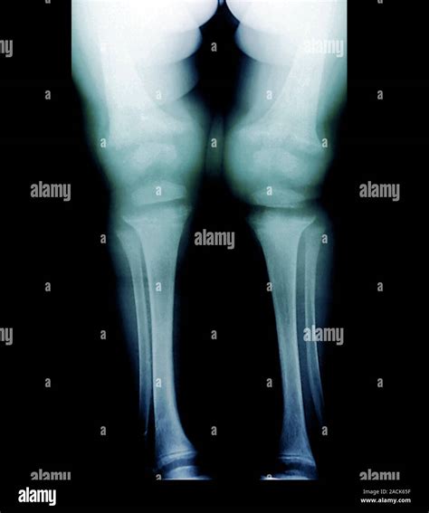 Rickets X Ray Shedding Light On Vitamin D Status And Its Complexities