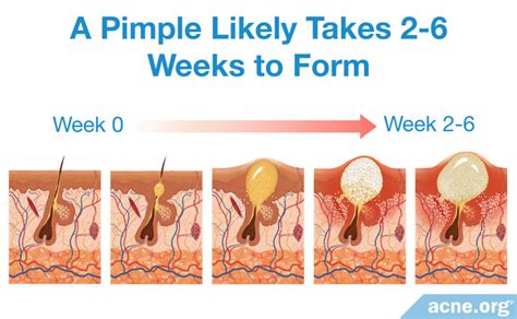 How Long Does It Take For A Pimple To Form From Clogged Pores Acne Org