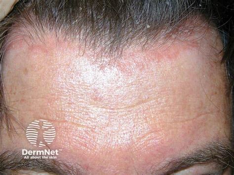 Scalp Psoriasis Image