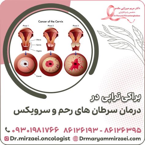 براکی تراپی در درمان سرطان های رحم و سرویکس دکتر میرزایی مقدم