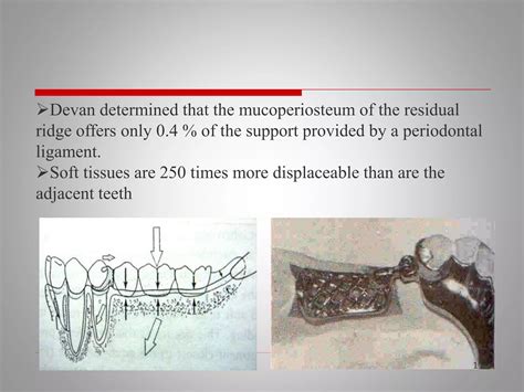 Designing For Kennedy Class I And Class Ii Ppt