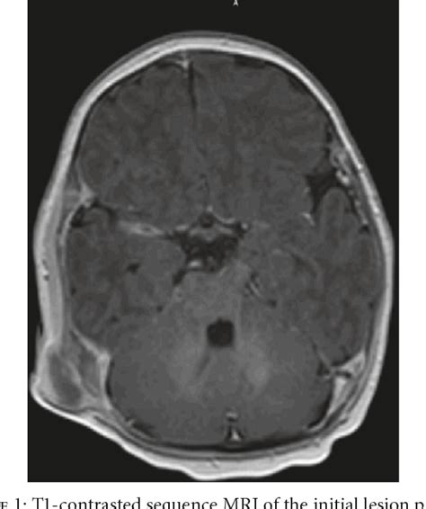 Figure 1 From Postauricular Melanocytic Neuroectodermal Tumor Of Infancy A Rare Site Of A Rare