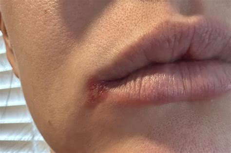 Cold Sore Or Angular Cheilitis R Dermatologyquestions