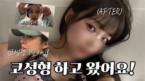 코성형 하고 왔어요 전후 후기 Youtube
