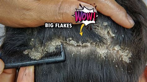 Scratching Dandruff Off Scalp Big Flakes Kolh