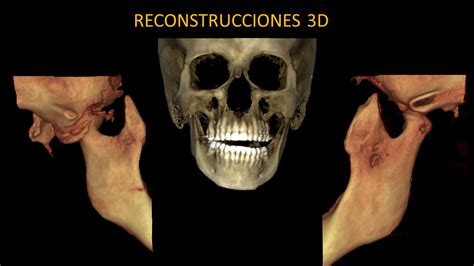Caso Clínico N° 715 Anquilosis Fibro Osea Atm Probable Cdi Perú