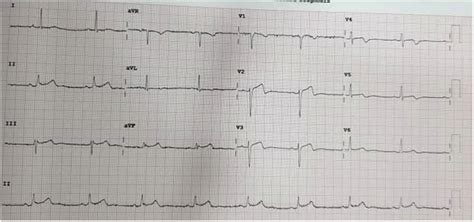 Tctap C 015 Wellens Syndrome The Widow Maker A Pre Infarction State
