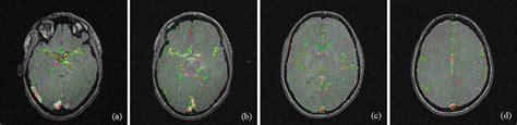 Sparsely Annotated Points On Tof Mra The Vascular Annotated Points And Download Scientific