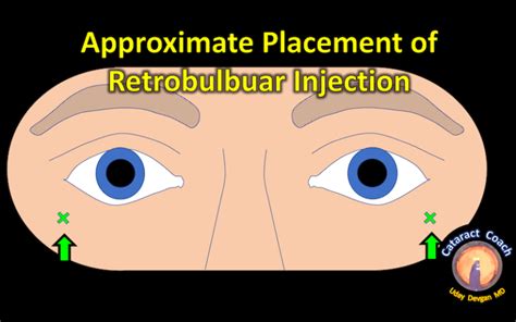 Technique For Retrobulbar Anesthetic Injection Cataract Coach