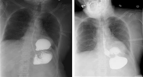 Upper Gastrointestinal Series Ugi Series Of A Patient At Our