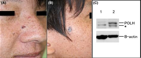 Xeroderma Pigmentosum Treatment
