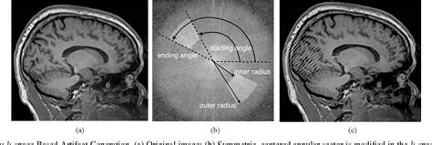 Figure 1 From Localized Motion Artifact Reduction On Brain Mri Using