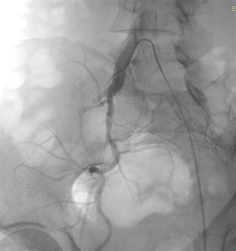 Intraoperational Angiography Of The Right Aorto Iliac Segment From Download Scientific Diagram