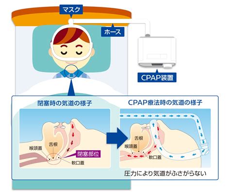 CPAP療法の役割 みやざきRCクリニック アレルギーいびき無呼吸外来呼吸器内科