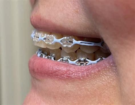 My Absolute Favorite Colors For Braces What Are Yours Rbraces