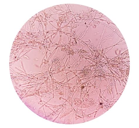 Premium Photo Pseudohyphae And Budding Yeast Cells In Patient Urine