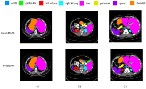 Shifttransunet An Efficient Deep Learning Model For Medical Image Segmentation Using Shiftvit