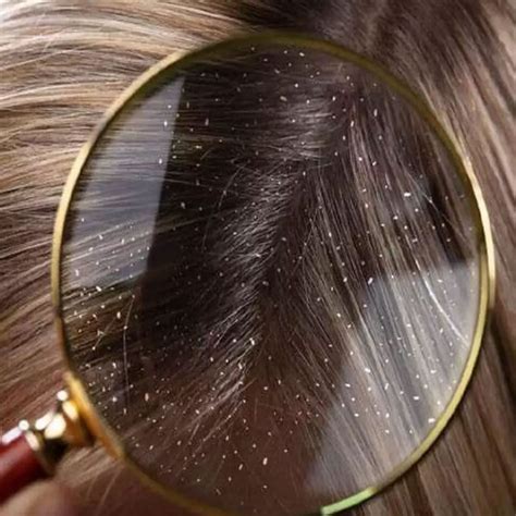 Scalp Problems Ang Skin Hair Clinic