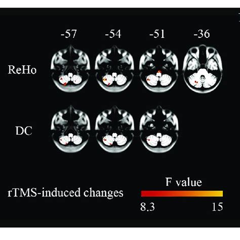 Pdf High Frequency Rtms Of The Motor Cortex Modulates Cerebellar And Widespread Activity As