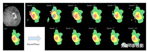 基于神经网络的脑肿瘤分割 知乎
