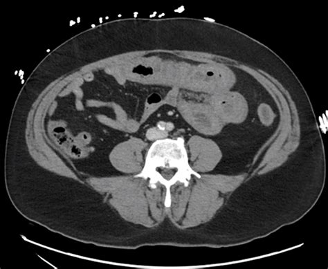 Severe Enteritis Due To Iga Vasculitis Leading To Negative Laparotomy