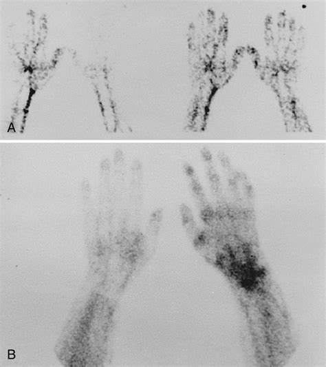 6 Three Phase Bone Scans A Phase I A Dynamic Phase Evaluates Download Scientific