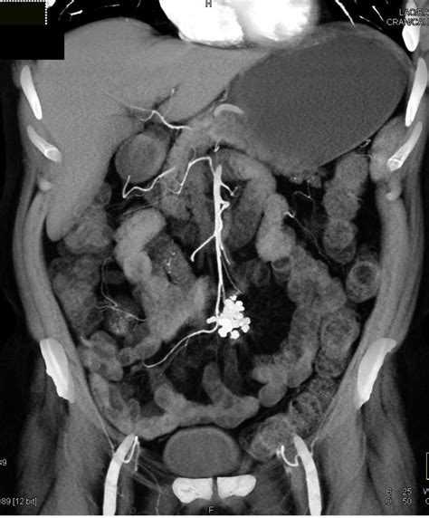 Mass In Mesentery Is Sclerosing Mesenteritis With Dense Calcification Small Bowel Radiology