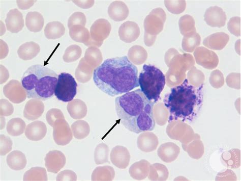 Basophilia In Chronic Myelogenous Leukemia