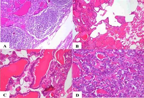 Submandibular Cervical Mass As The First Presenting Sign Of Fvptc A Case Report And Review Of