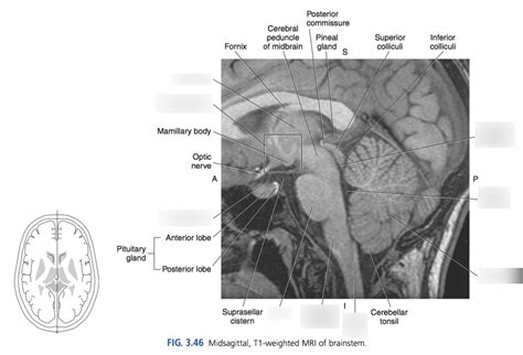 Anatomy Brainstem Mri At Oscar Goff Blog