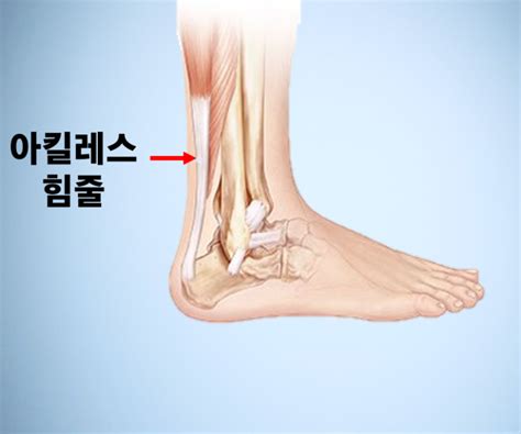 발통증부위별 원인 완벽정리 뒤꿈치 옆 앞꿈치 발바닥 발등 네이버 블로그