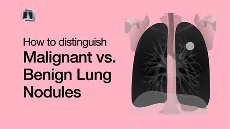 Distinguish Malignant Vs Benign Lung Nodules Youtube
