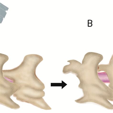 Illustration Of Intraspinal Intrathecal Injection Site And Angle First Download Scientific
