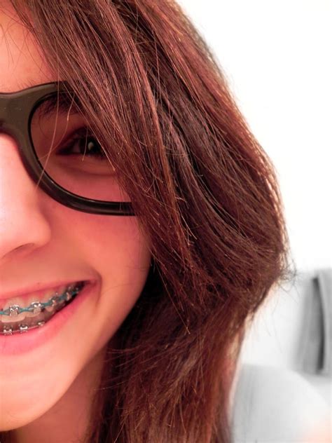 Brace Face By Bruised Bones On Deviantart