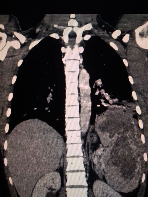 Splenic Abscess Radiology Case