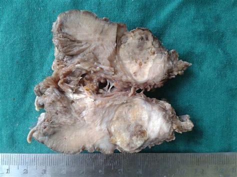 Partly Encapsulated Solid Greyish White To Greyish Yellowish Tumour Download Scientific Diagram