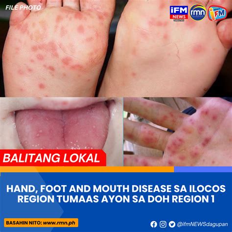 Hand Foot And Mouth Disease Sa Ilocos Region Tumaas Ayon Sa Doh Region