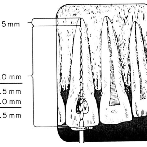 Calculation Of The Working Length Of The Root Canal [2] Download Scientific Diagram