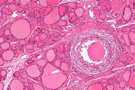 Subacute Granulomatous Thyroiditis Key Facts