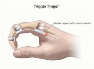 Trigger Finger Surgery In Utah St George Surgical Center