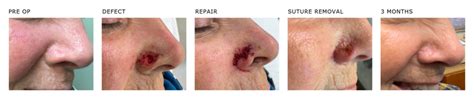 Mohs Surgery Photos Before And After Adc Derm