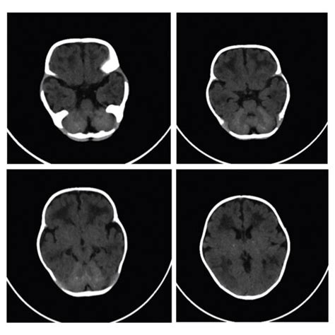 Brain Ct Scan Diffuse Calcifications Involving Both Lobes As Well As Download Scientific