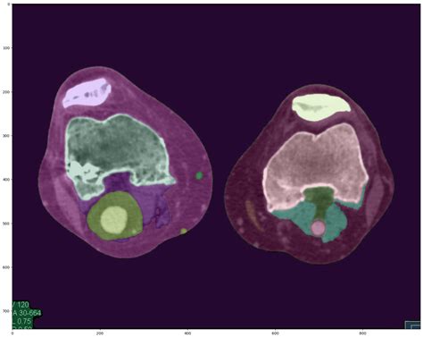 Ct Scan Pre Processing To Enhance Paa Segmentation Accuracy Punit Arani
