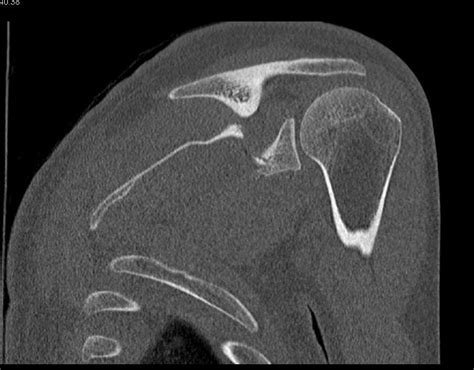 Scapula Fracture Ct Scan At David Rogge Blog