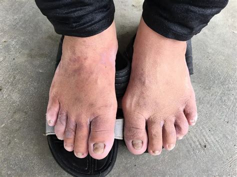 Foot Rash Causes Symptoms Home Remedies And Treatment Pictures