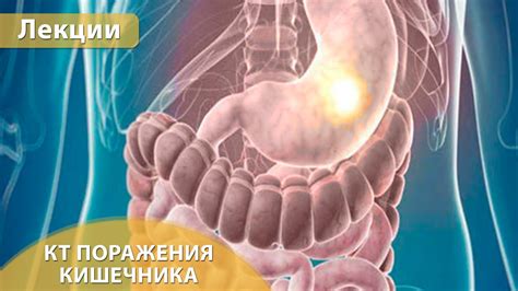 Часть 3 КТ поражений кишечника аппендицит дивертикулит аппендагит Андрей Мангов Youtube